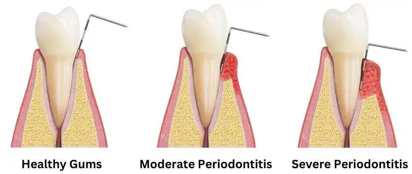 Expert Gum Disease Treatments At Aptos Periodontics