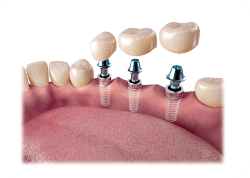 Reclaim Your Smile Today - Dental Implant Experts In Aptos